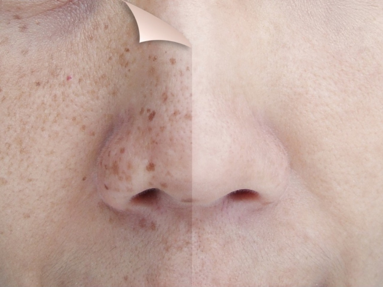 Perawatan dalam Mengatasi Dark Spot yang Diakui Keampuhannya oleh Para ...
